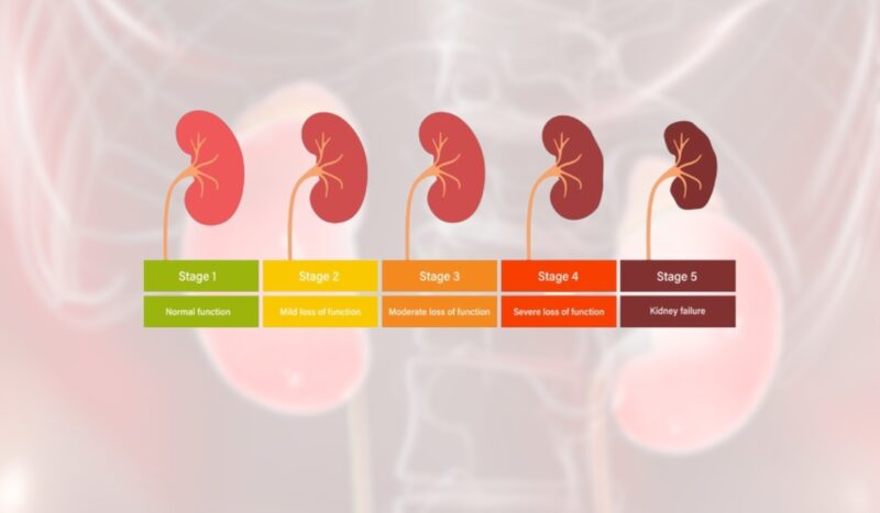 Hypertensive Nephropathy: A Silent Threat to Your Kidney Health
