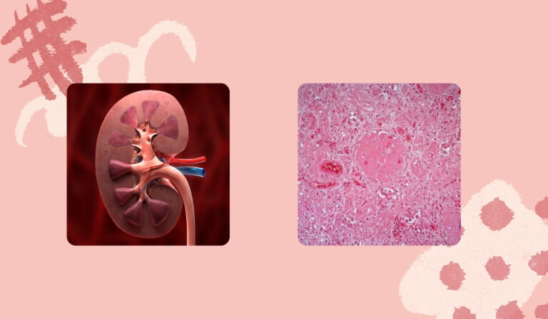 Hypertensive Nephropathy: A Silent Threat to Your Kidney Health