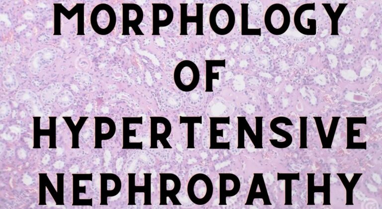Hypertensive Nephropathy: A Silent Threat to Your Kidney Health