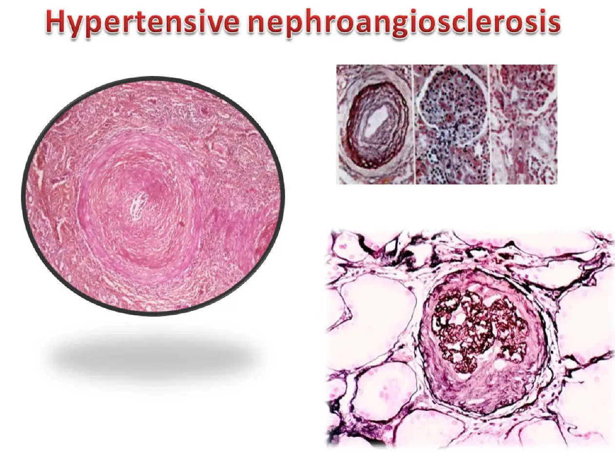 Hypertensive Nephrosclerosis Archives - Pathway Medicine