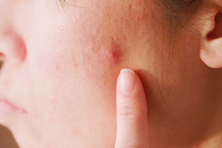 Why Do Teenagers Get Acne - Why It's More Than Just a Skin Issue