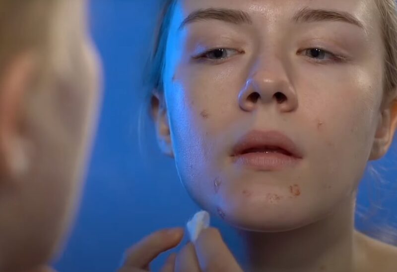 What is Cystic Acne? Learn the Symptoms & Treatment Options - Pathway ...